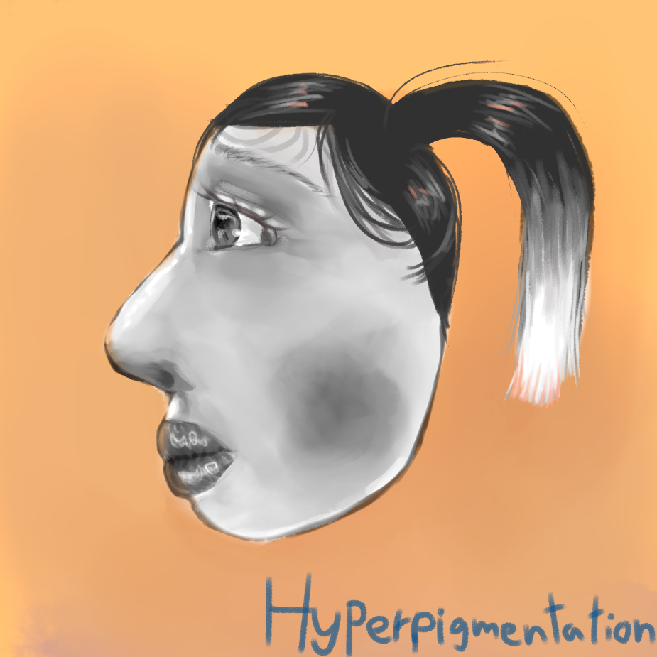 Hyperpigmentation - ibisPaint