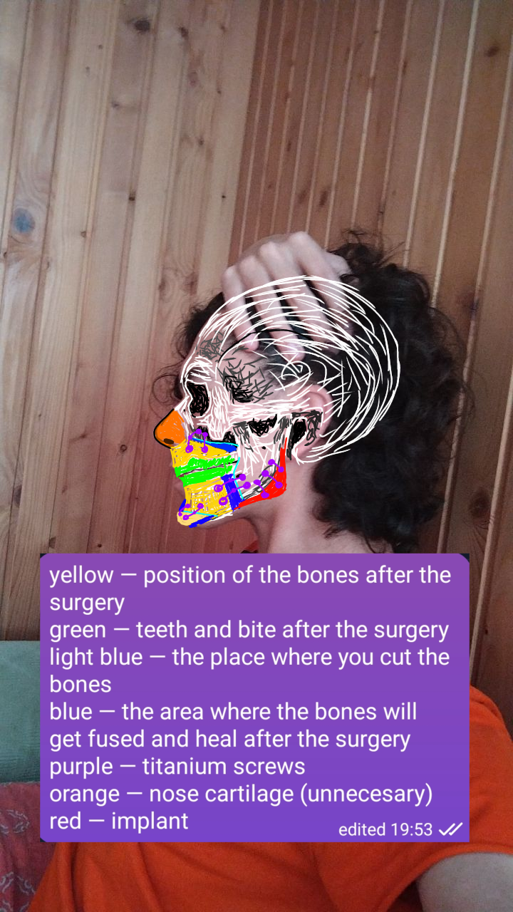 Bimax AKA double jaw surgery - ibisPaint