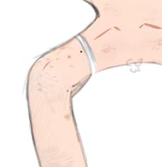 shoulder with acne. - ibisPaint